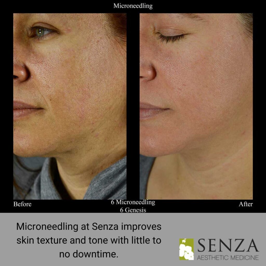 Microneedling vs. Chemical Peels: Charting Your Course to Radiant Skin